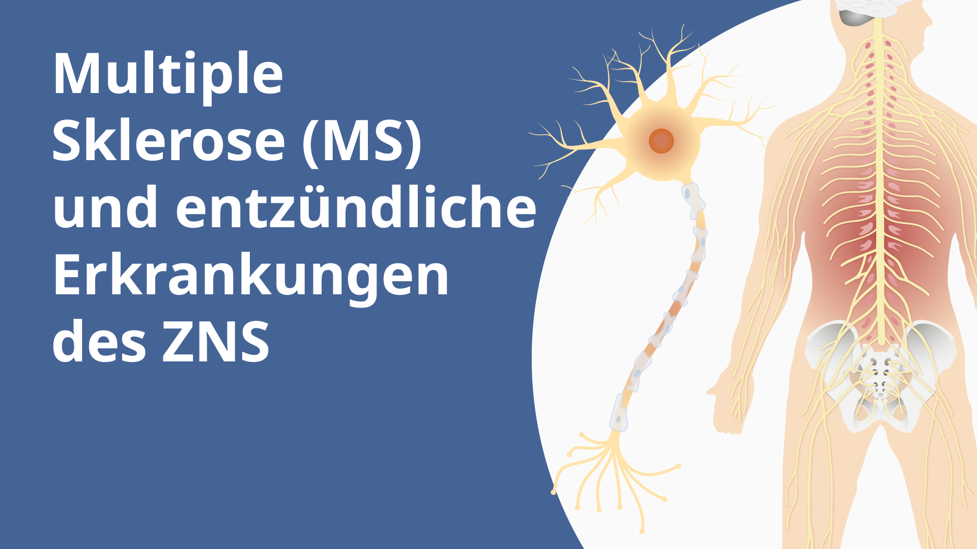 Multiple Sklerose (MS): Management – Online Vortrag | Lecturio