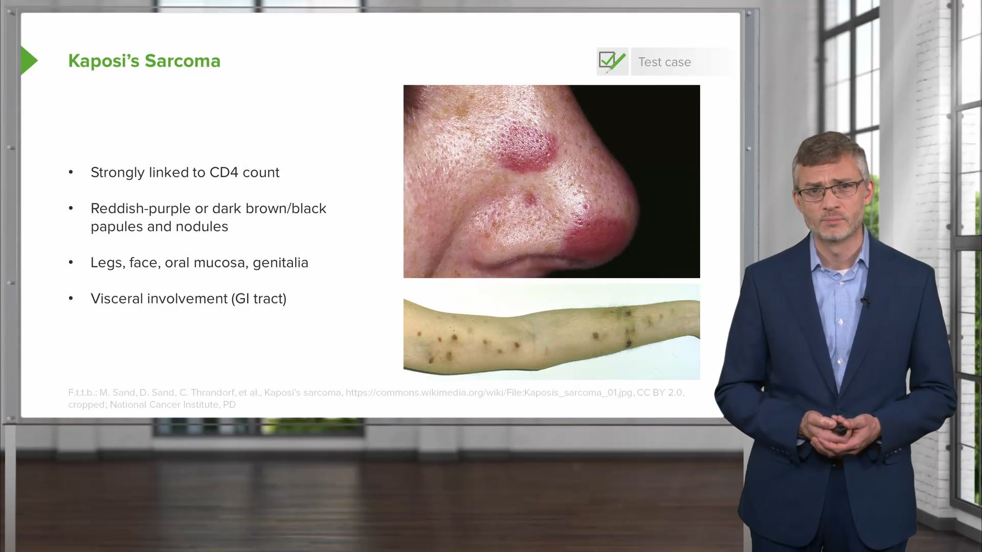 Neoplasms Of The Skin Online Derma Course Lecturio Neoplasms Of The Skin Online Derma Course Lecturio