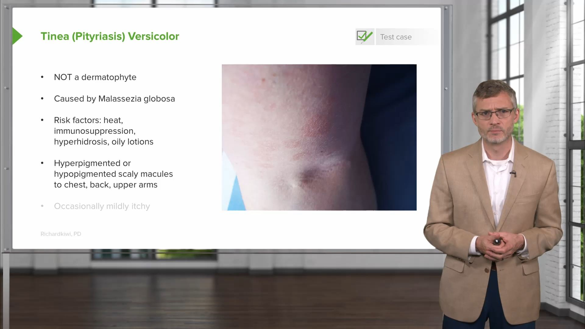Acrochordon (Skin Tag) – Online Derma Lecture | Lecturio